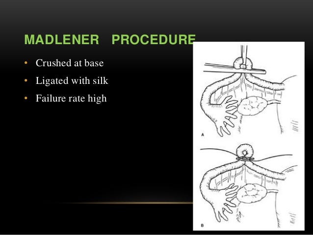 Female sterilisation
