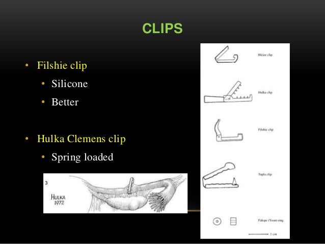 Female sterilisation