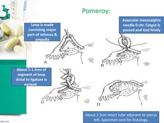 Female sterilisation | PPTX