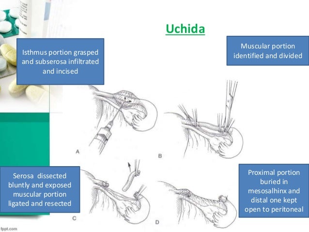 Female sterilisation