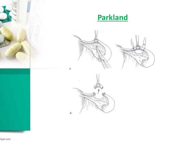 Female sterilisation