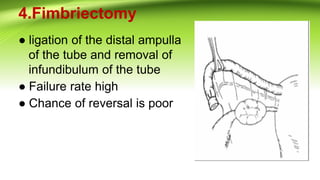 Female sterilisation | PPT