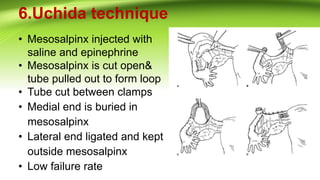Female sterilisation | PDF