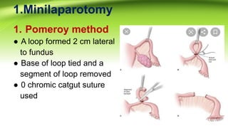 Female sterilisation | PDF