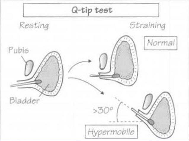 Female urinary incontinence