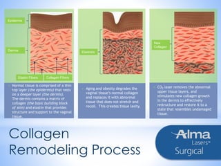 Age Defy FemiLift Procedure | PPTX