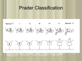 Feminizing genitoplasty in CAH patients | PPT