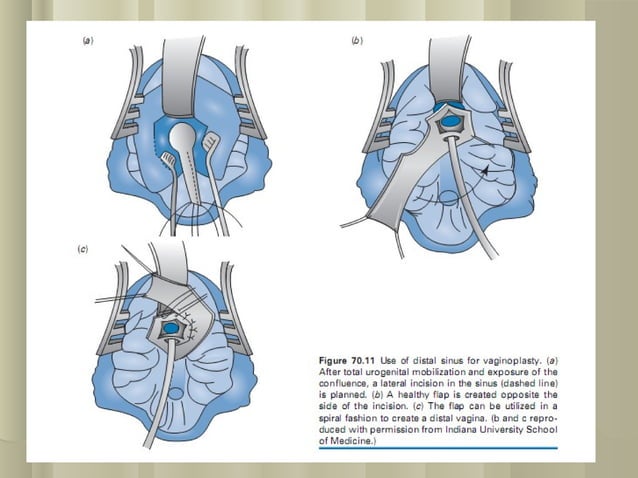Feminizing genitoplasty in CAH patients | PPT
