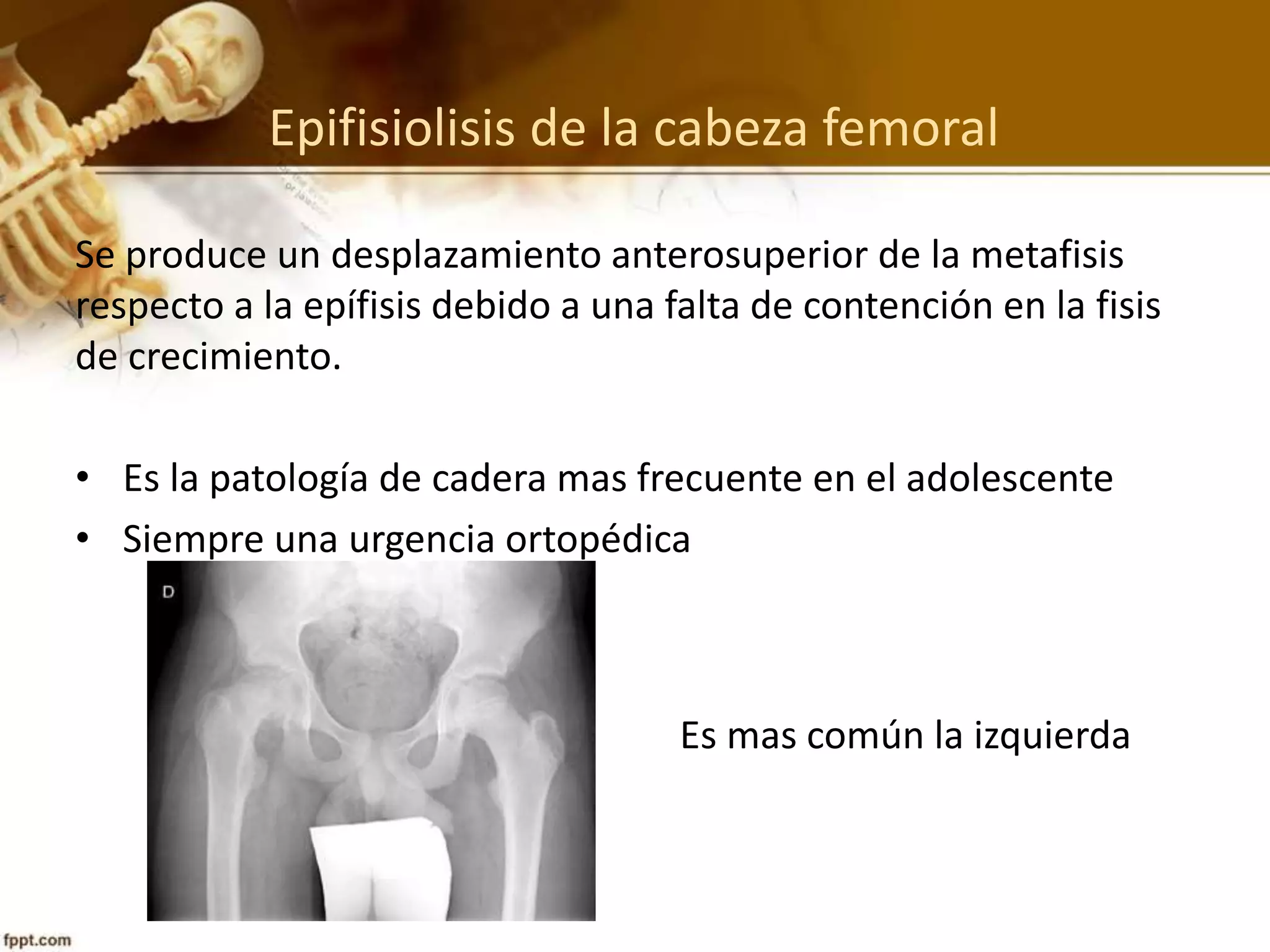 Epifisiolistesis Femoral | PPTX