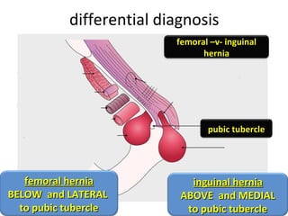 femoral-hernia4627-160120091851.pdf