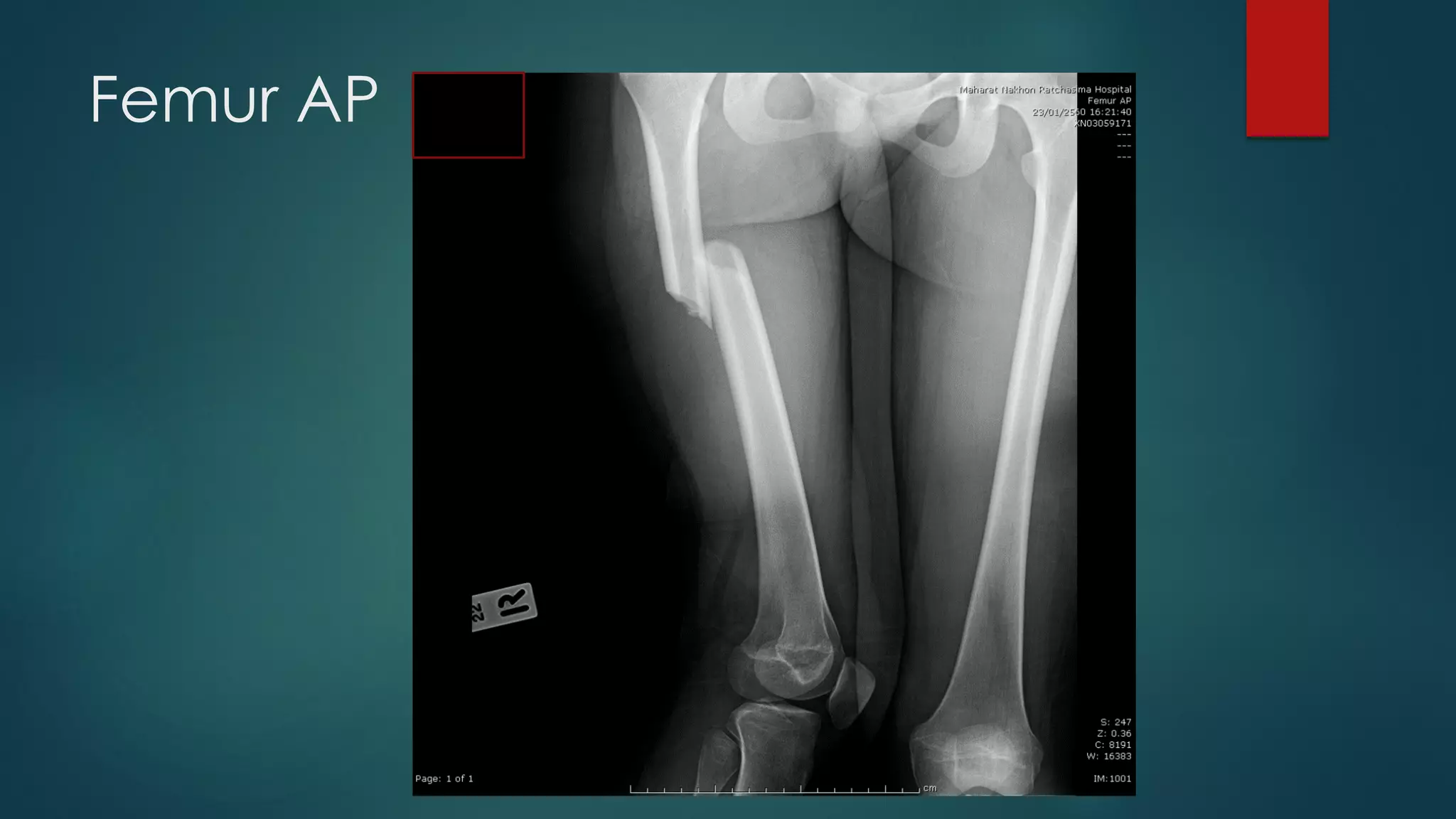Femoral shaft-fractures | PPT