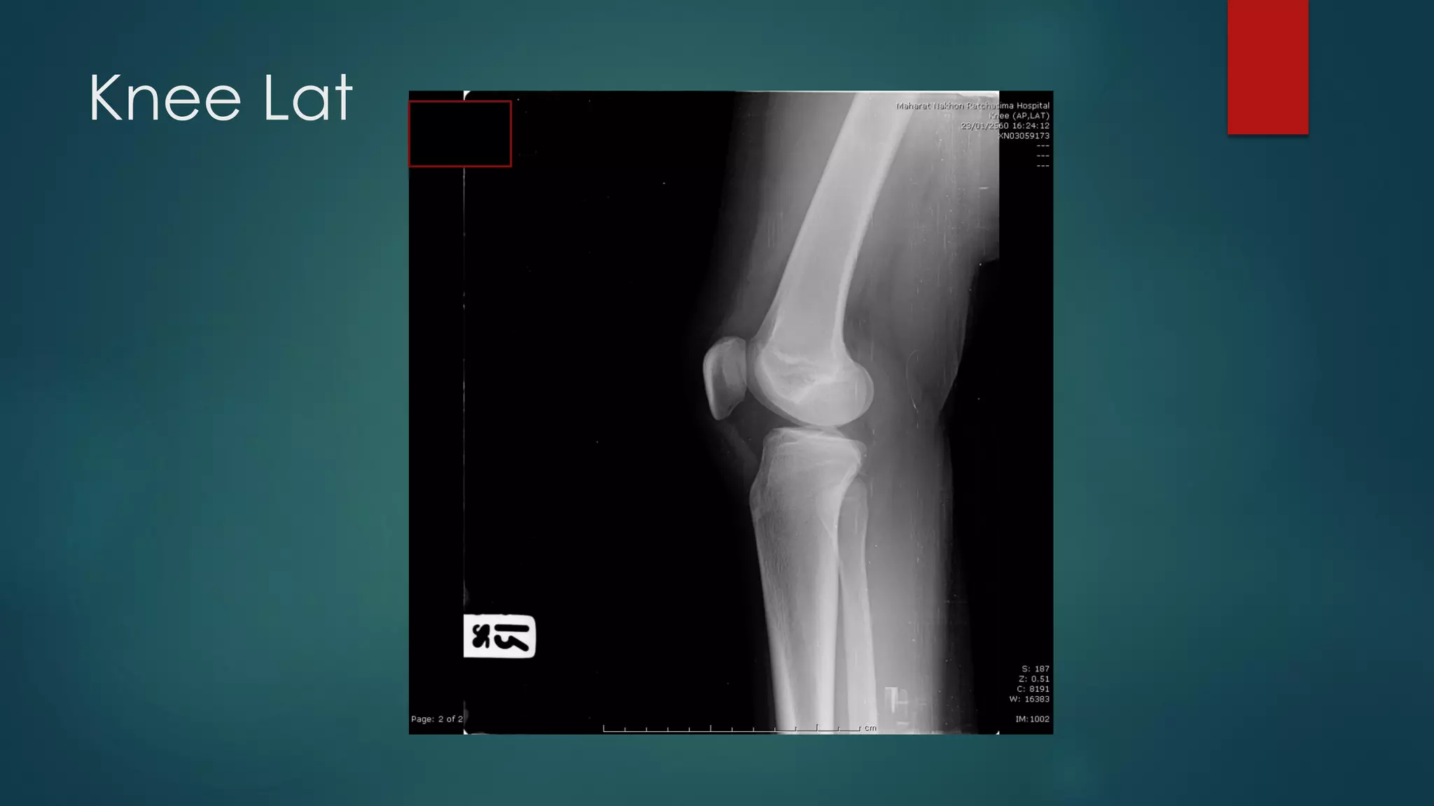 Femoral shaft-fractures | PPT