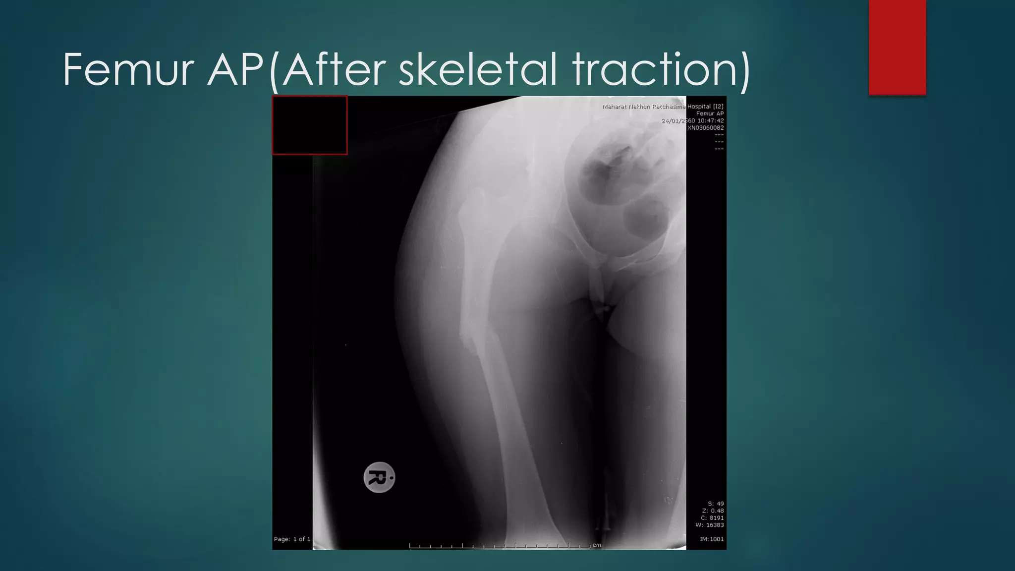 Femoral shaft-fractures | PPT