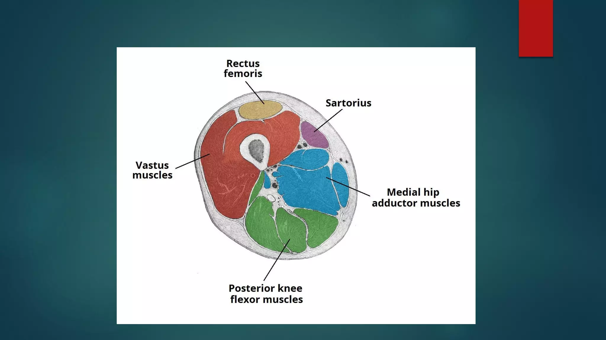 Femoral shaft-fractures | PPT
