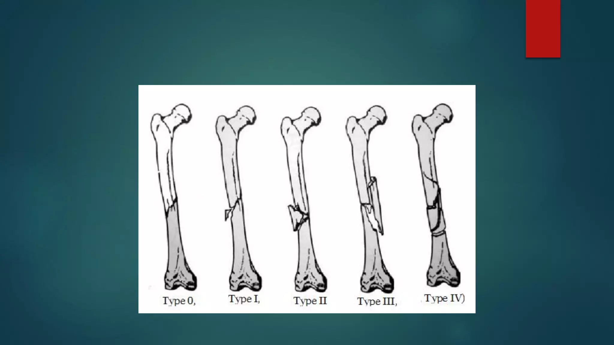 Femoral shaft-fractures | PPT