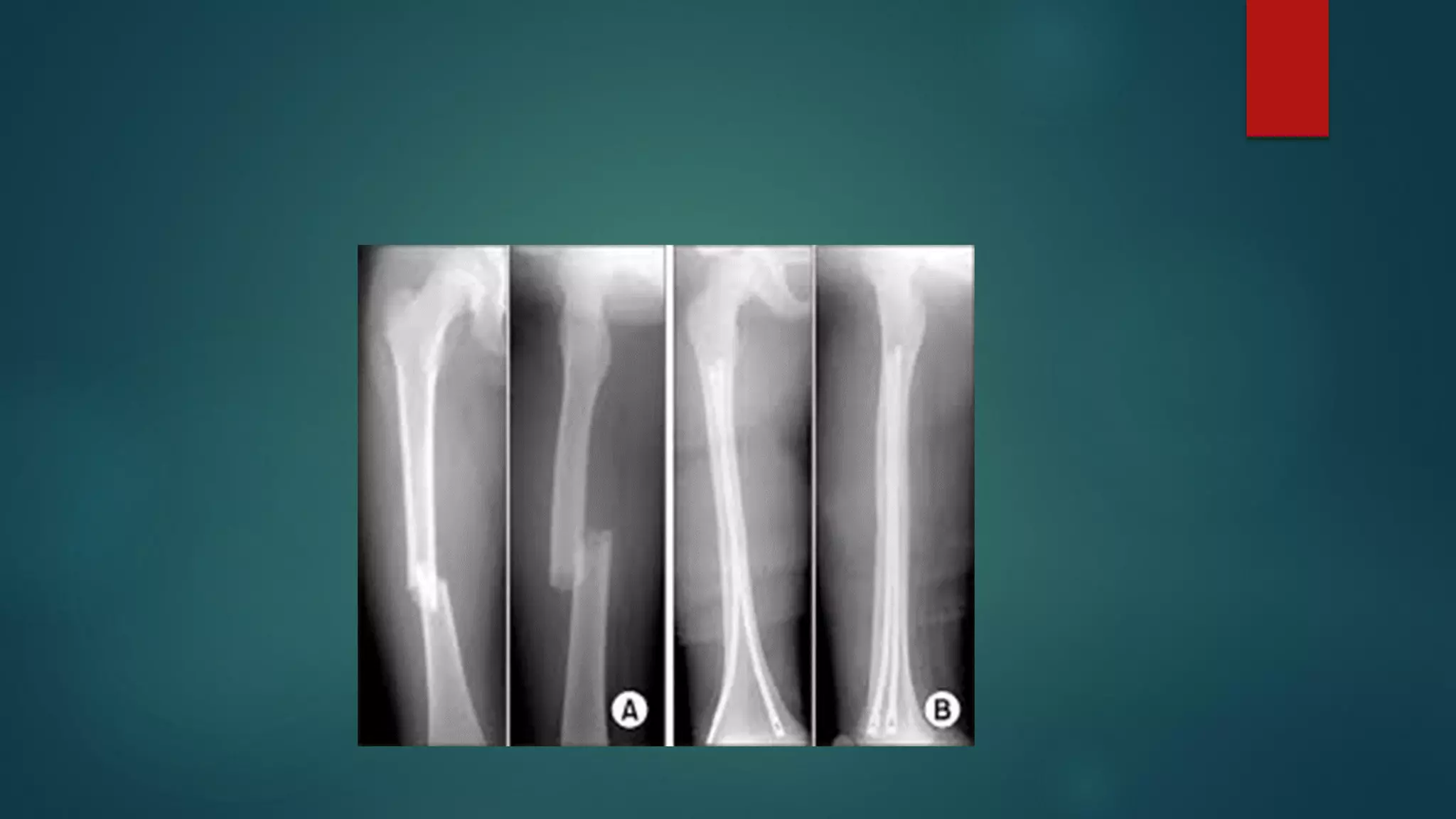 Femoral shaft-fractures | PPT