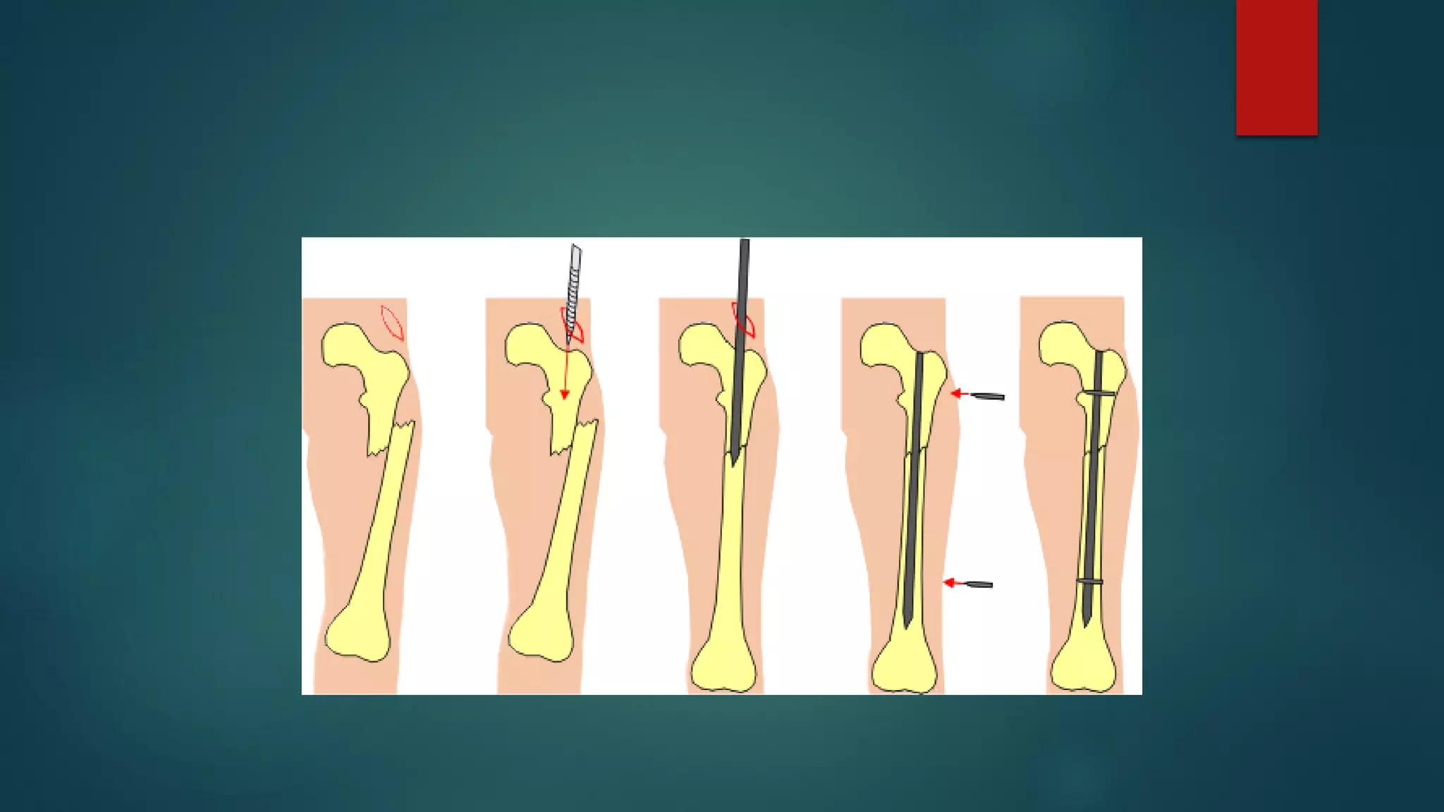 Femoral shaft-fractures | PPT