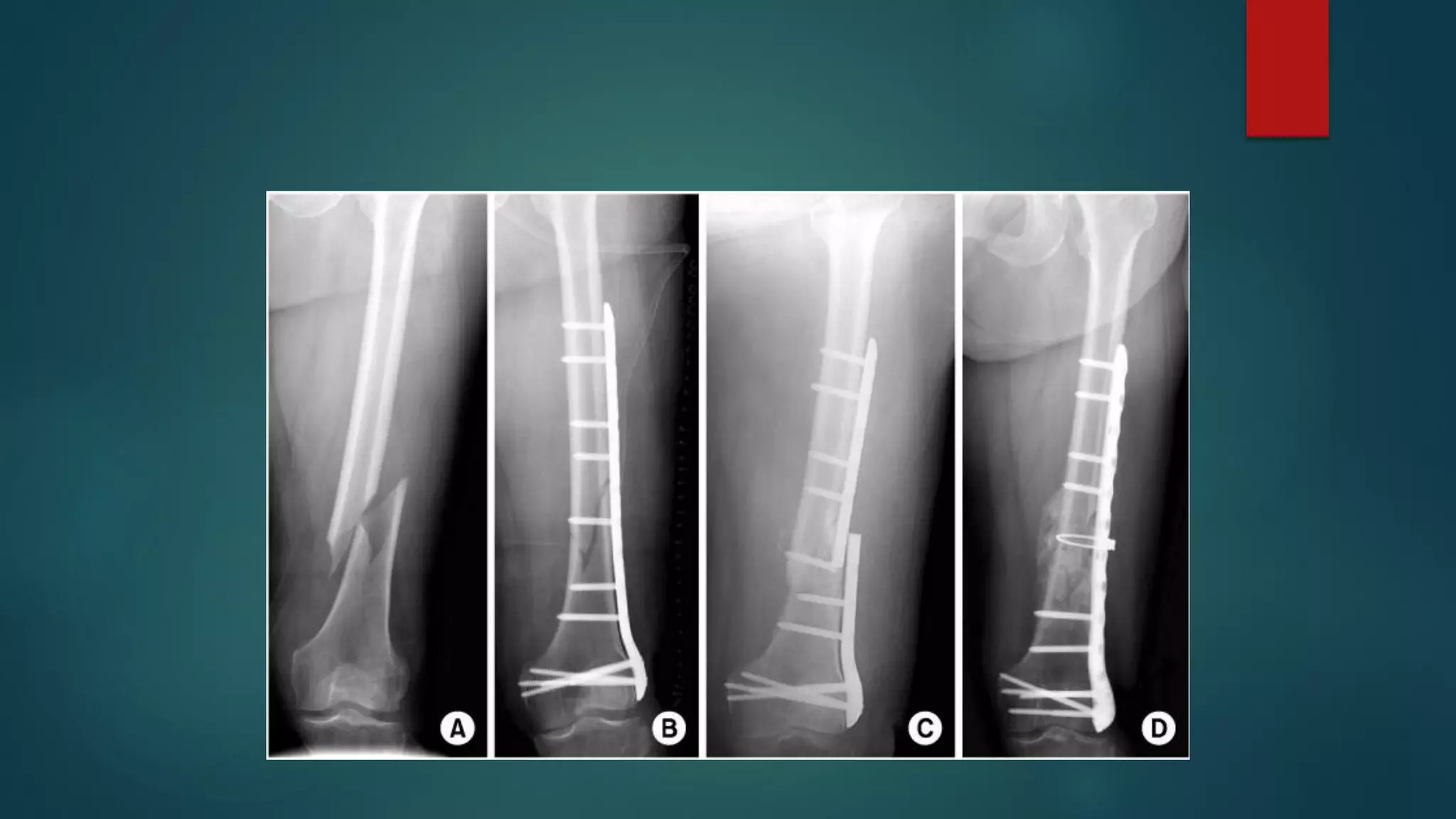Femoral shaft-fractures | PPT