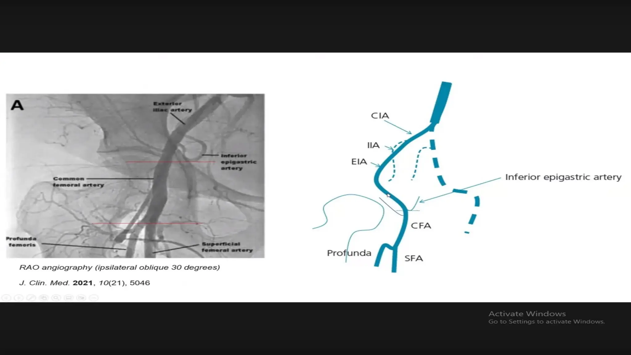 Femoral Access cardiology angiography.pptx