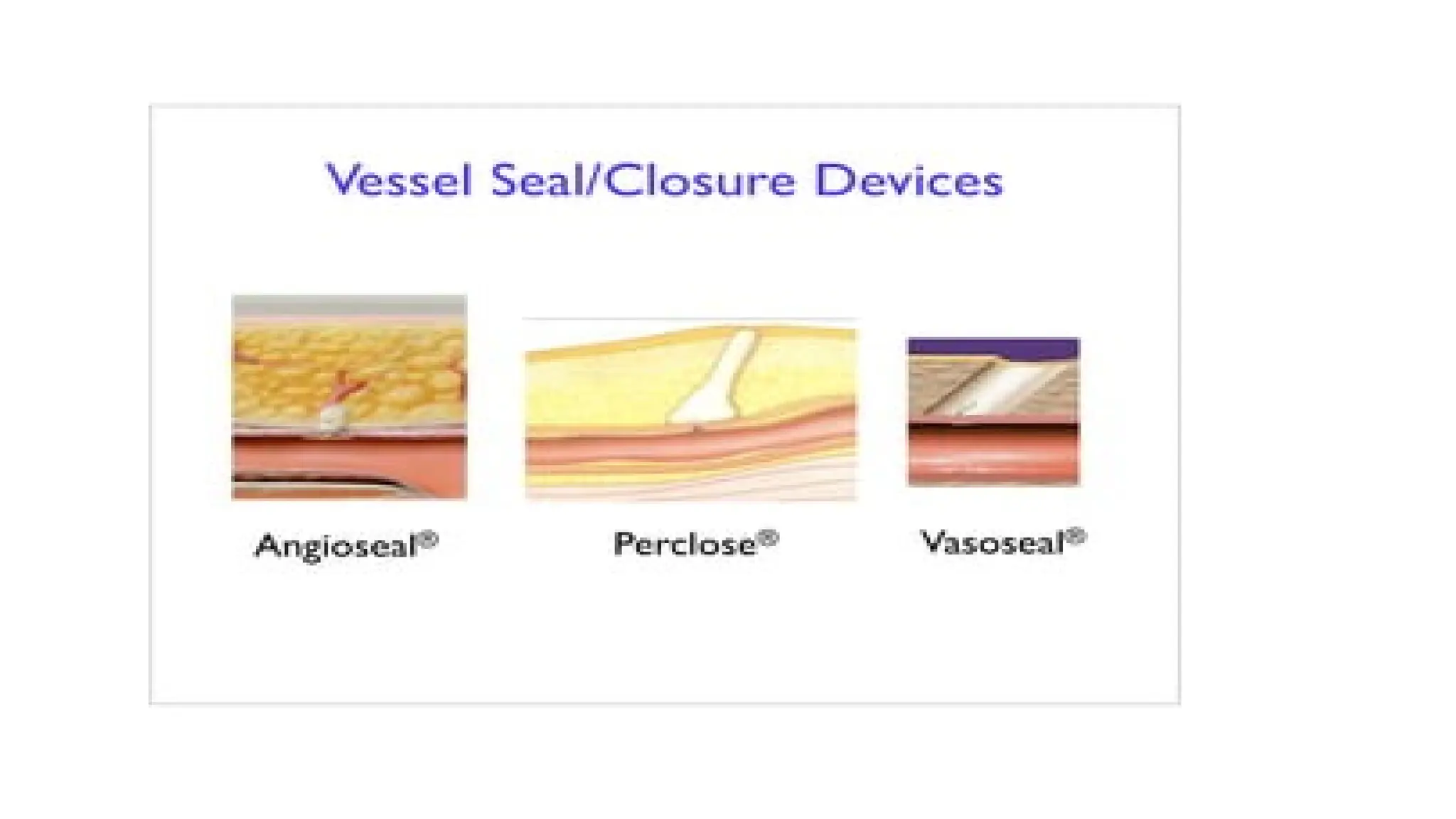 Femoral Access cardiology angiography.pptx