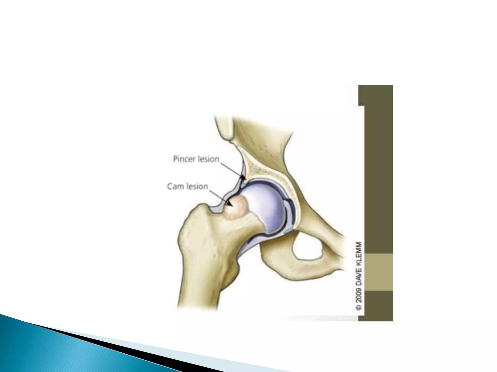 Femoral acetabular impingement sydrome | PPT