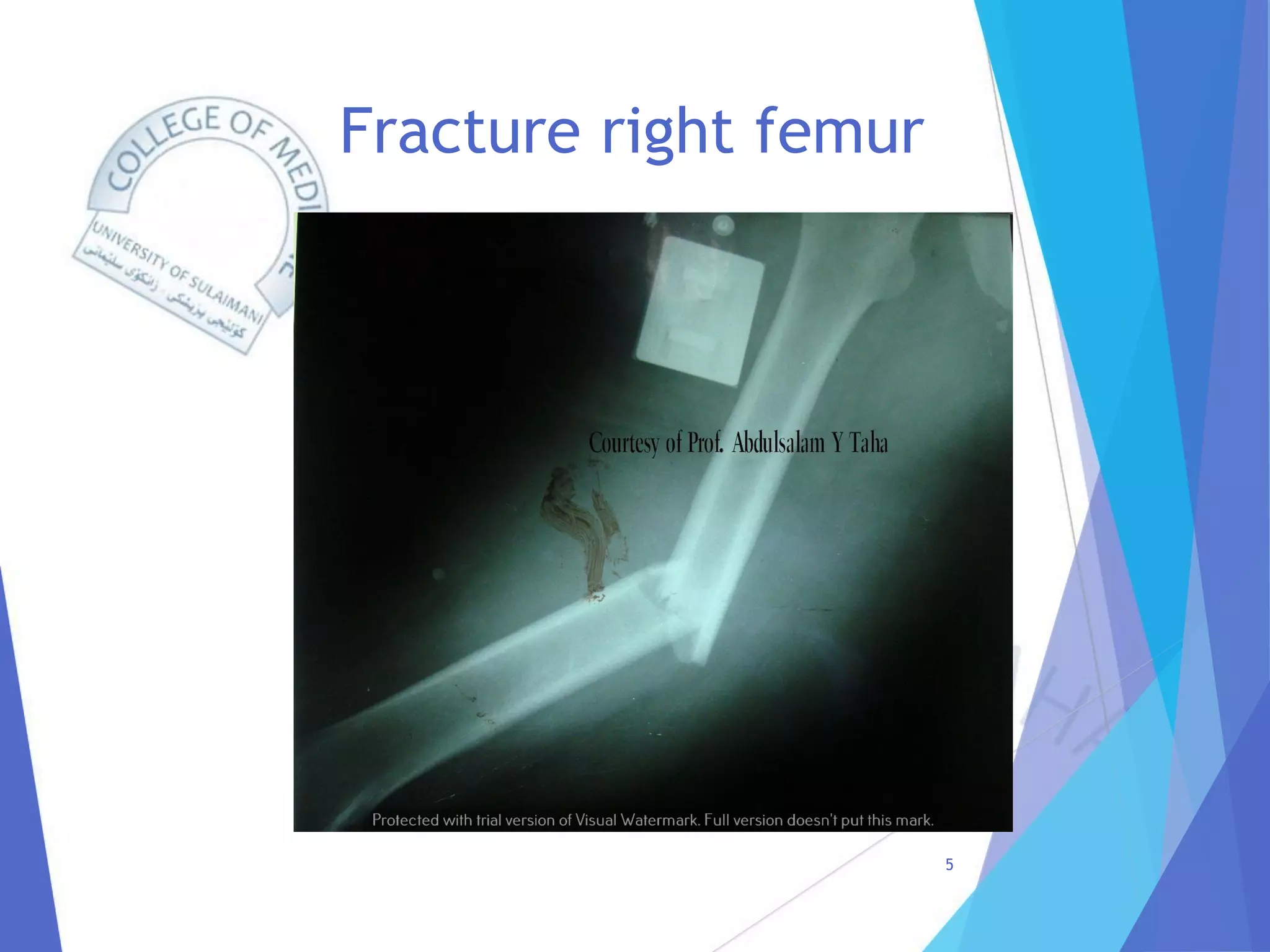 Femoral Artery Injury associated with Fracure Femur.pdf