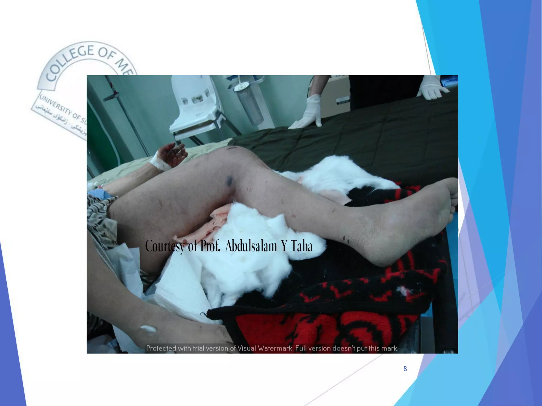 Femoral Artery Injury associated with Fracure Femur.pdf