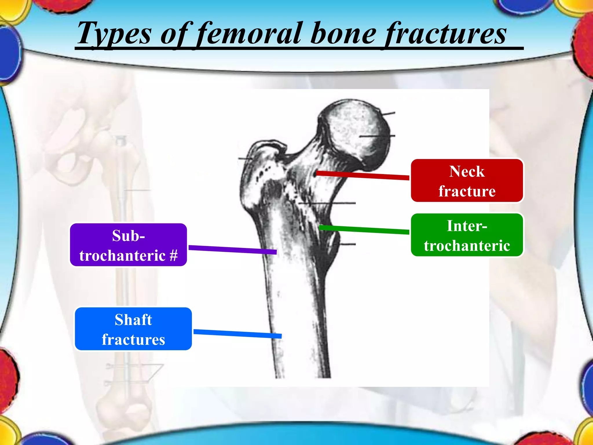 Femoral bone fracture | PPTX