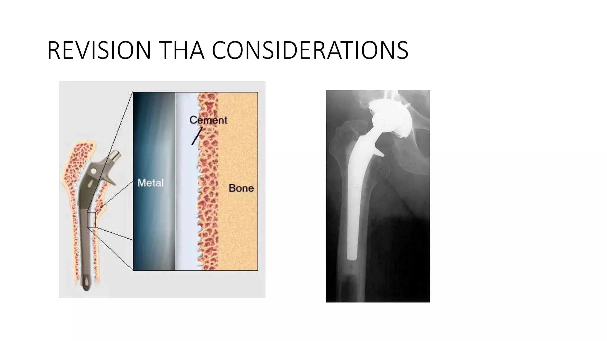 femoral bone assessment.pptx