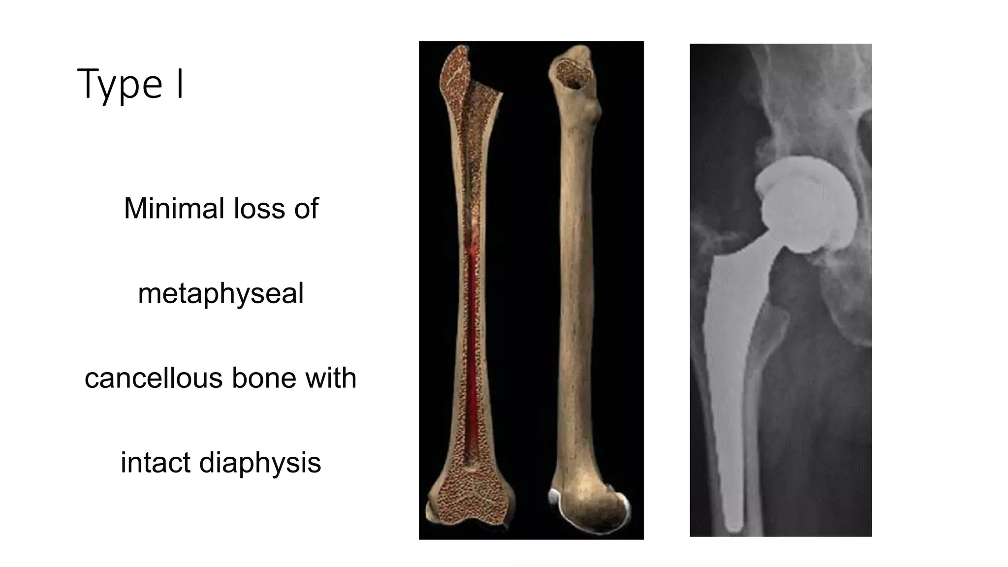 femoral bone assessment.pptx