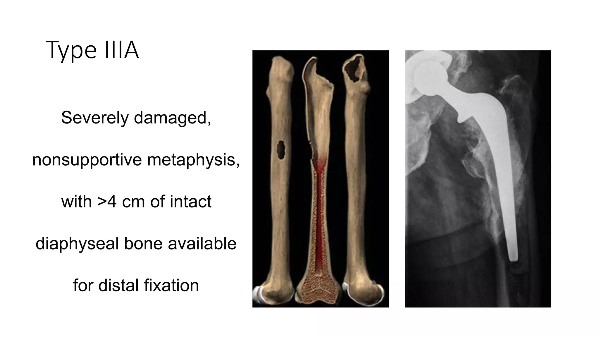femoral bone assessment.pptx