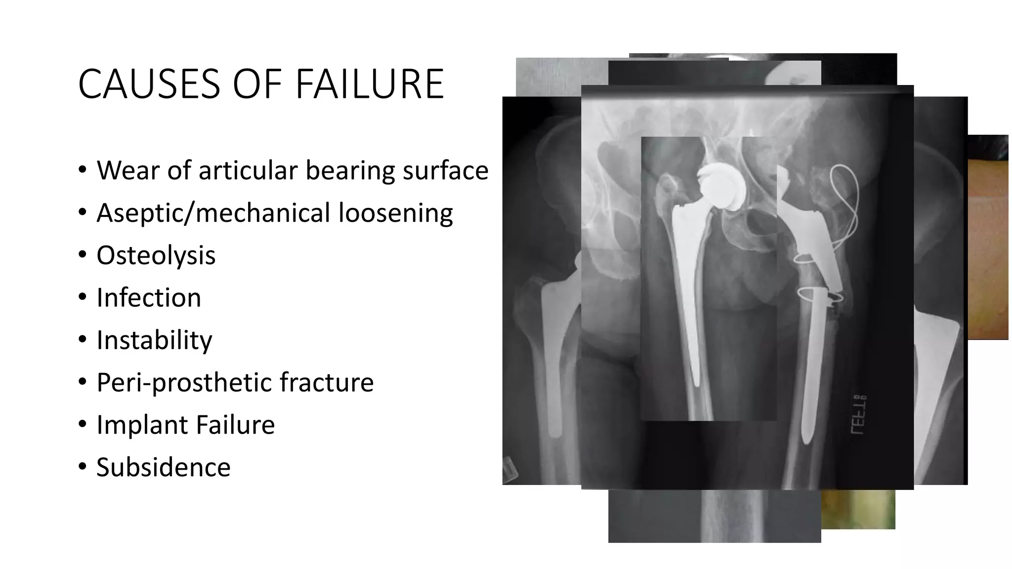 femoral bone assessment.pptx