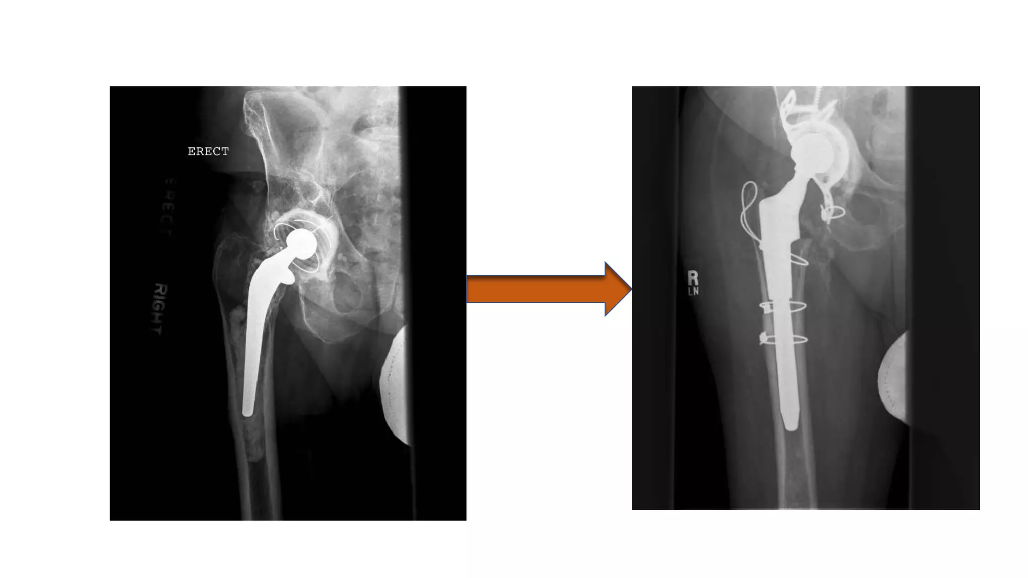 femoral bone assessment.pptx