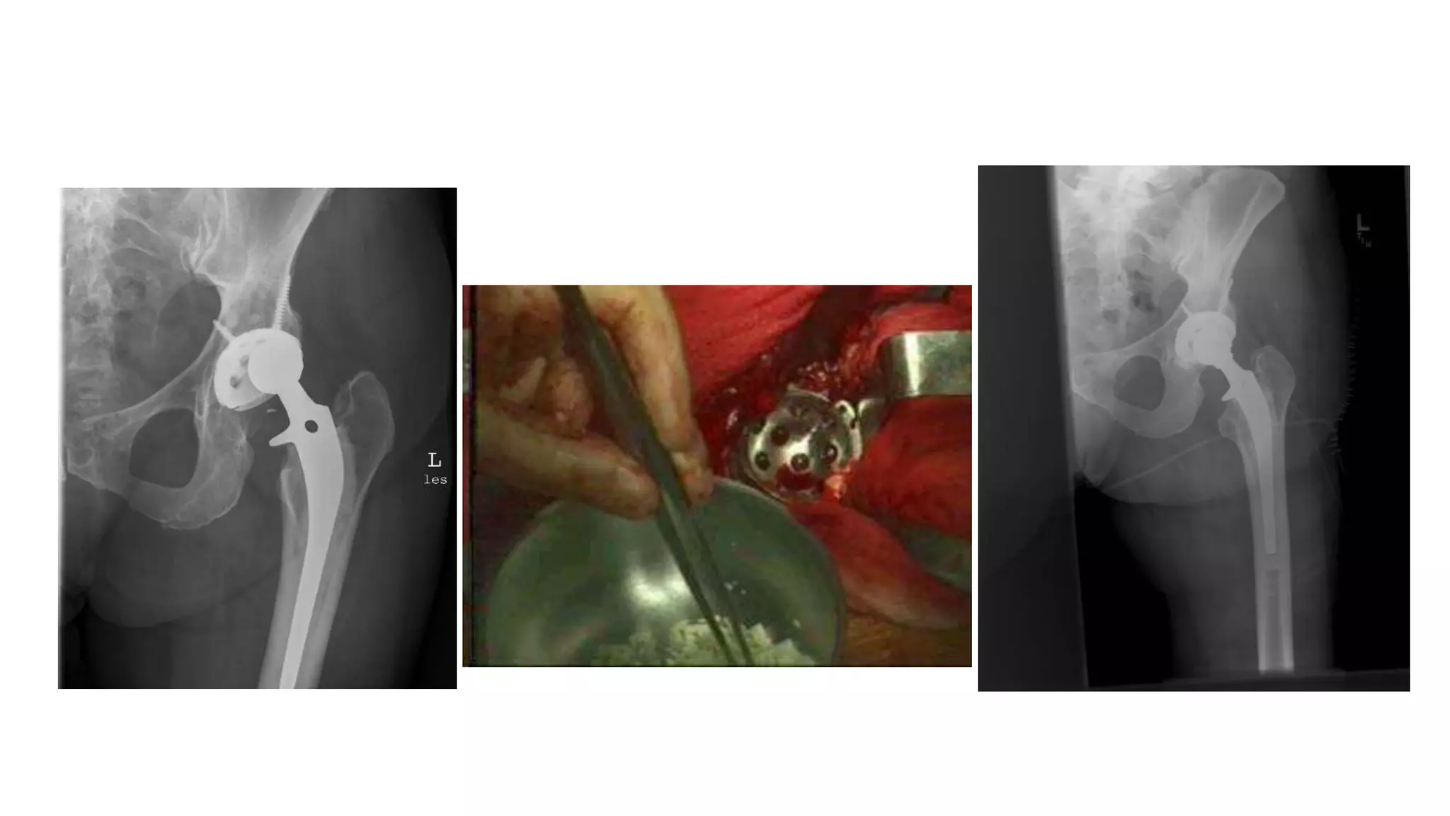 femoral bone assessment.pptx