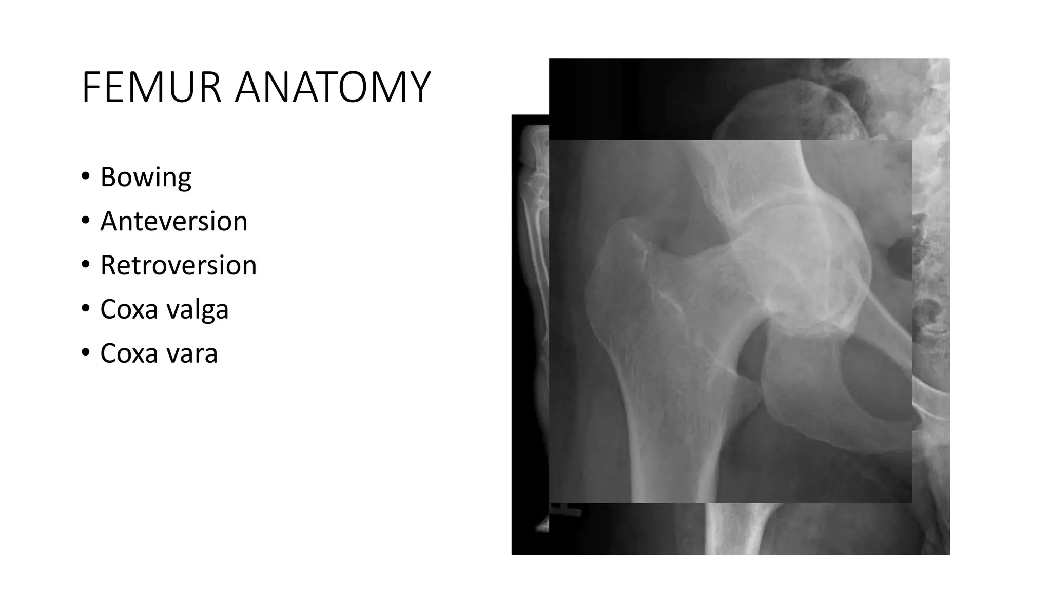 femoral bone assessment.pptx