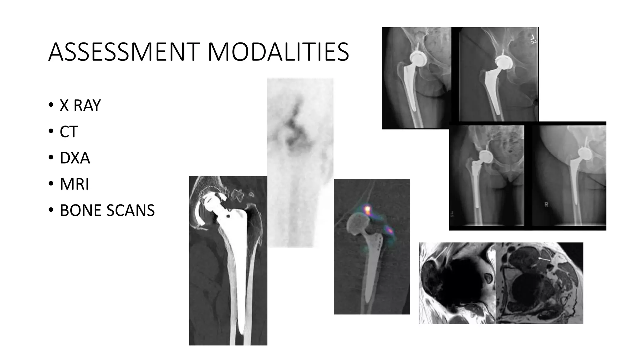 femoral bone assessment.pptx