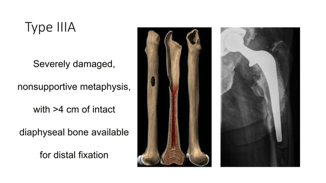 femoral bone assessment.pptx