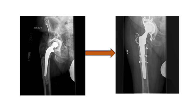 femoral bone assessment.pptx