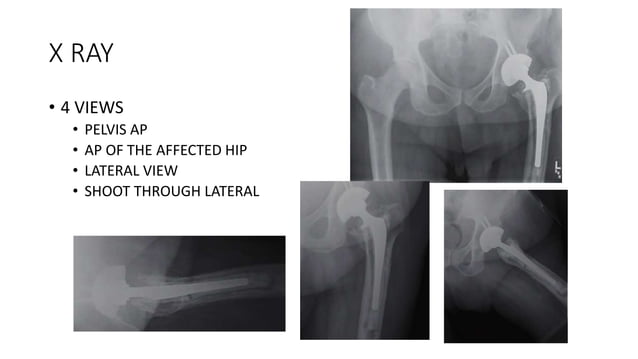 femoral bone assessment.pptx