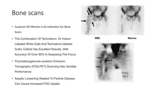 femoral bone assessment.pptx