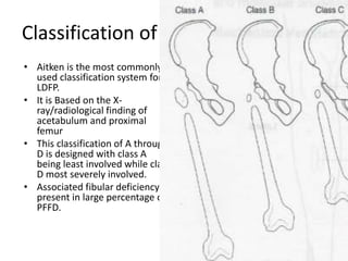Femoral deficiency and Prosthetic Management (part 1).pptx