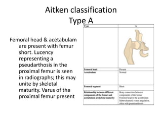 Femoral deficiency and Prosthetic Management (part 1).pptx