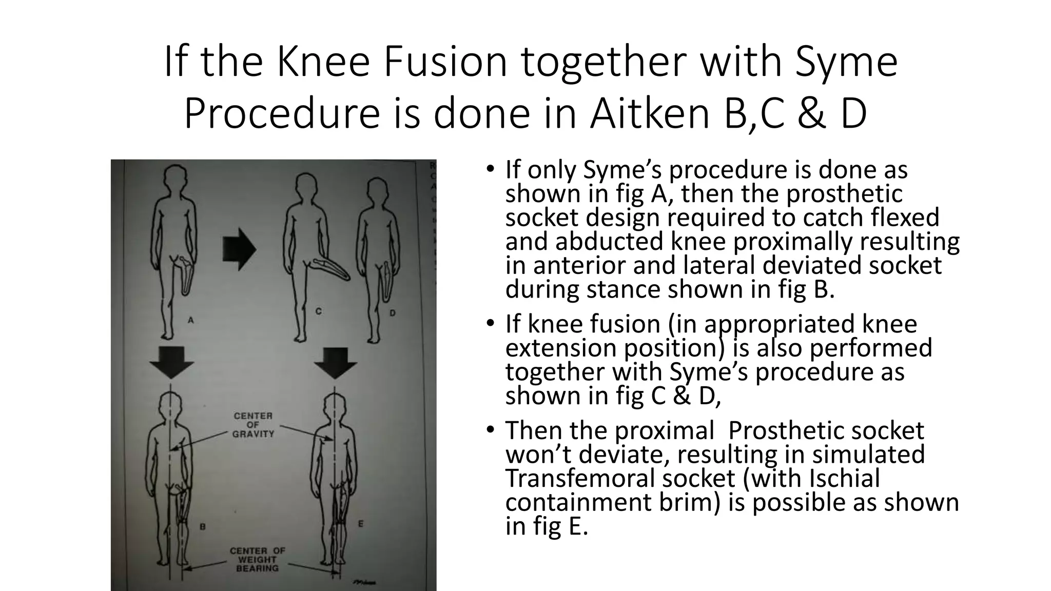 Femoral deficiency and Prosthetic management (part 2.pptx