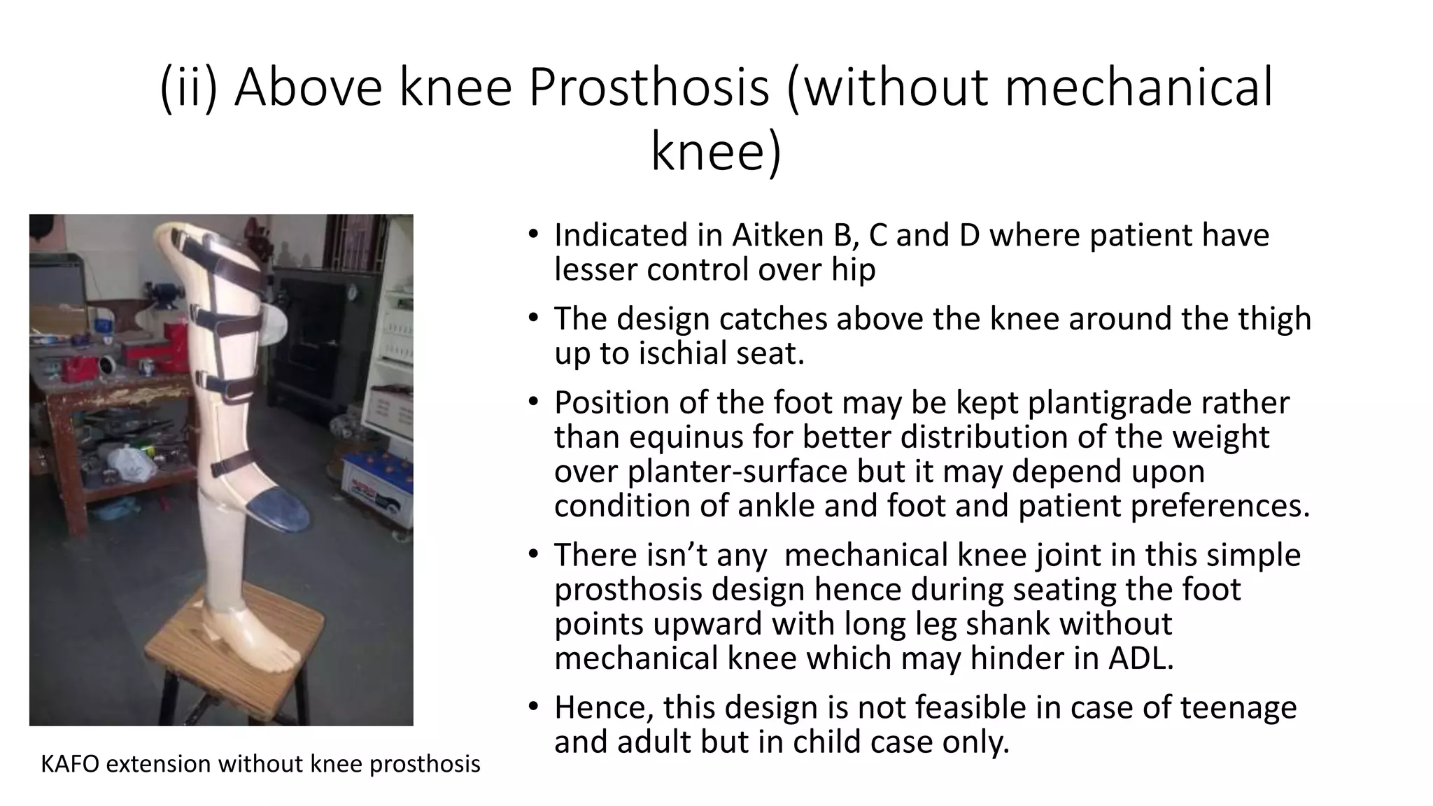 Femoral deficiency and Prosthetic management (part 2.pptx