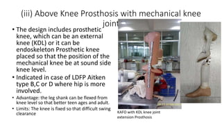 Femoral deficiency and Prosthetic management (part 2.pptx