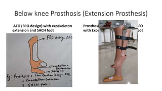 Femoral deficiency and Prosthetic management (part 2.pptx