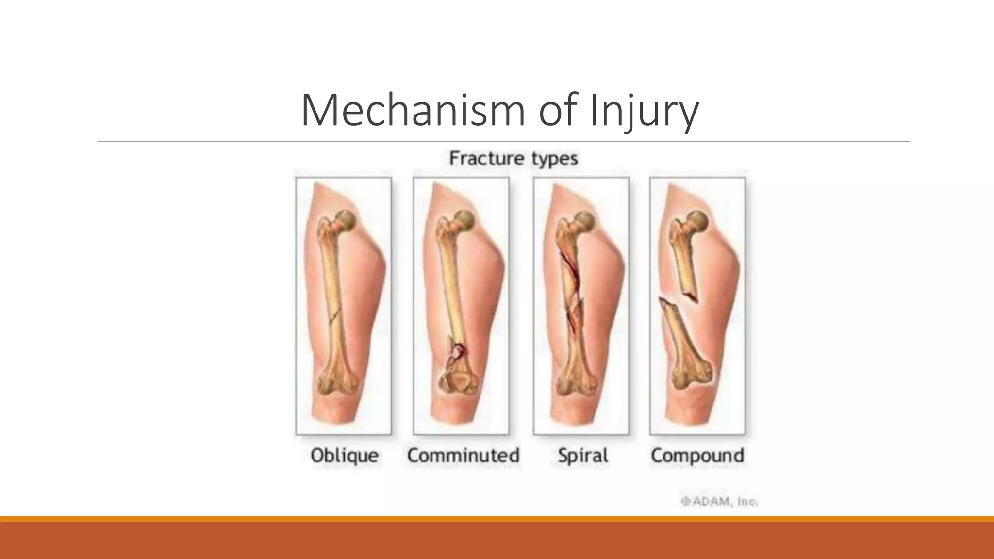 Femoral Shaft fracture | PPTX