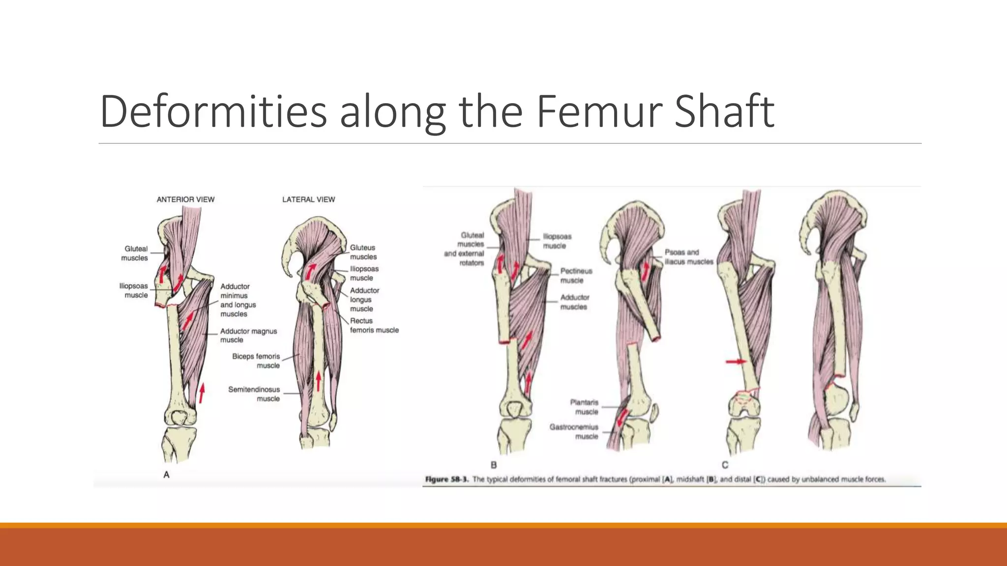 Femoral Shaft fracture | PPTX