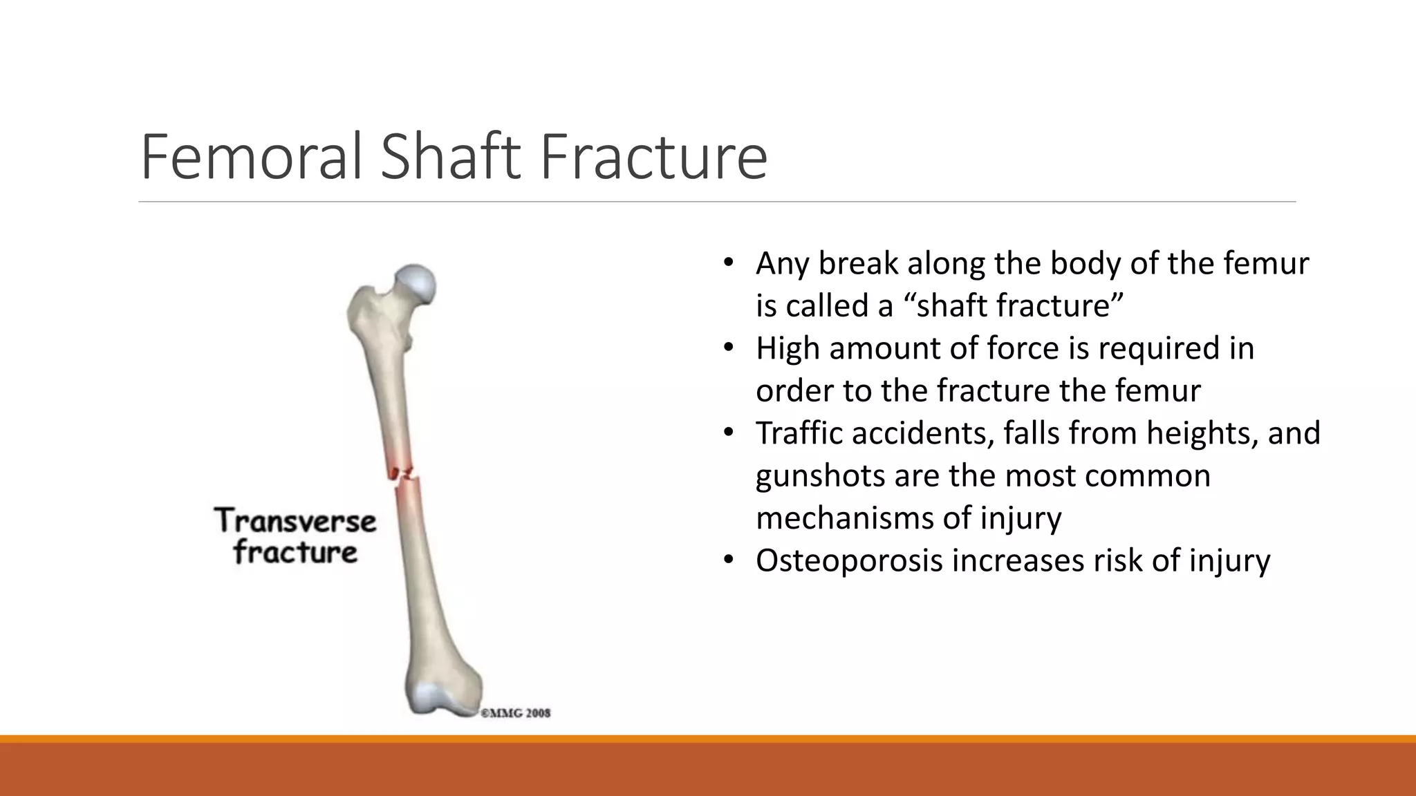 Femoral Shaft fracture | PPTX