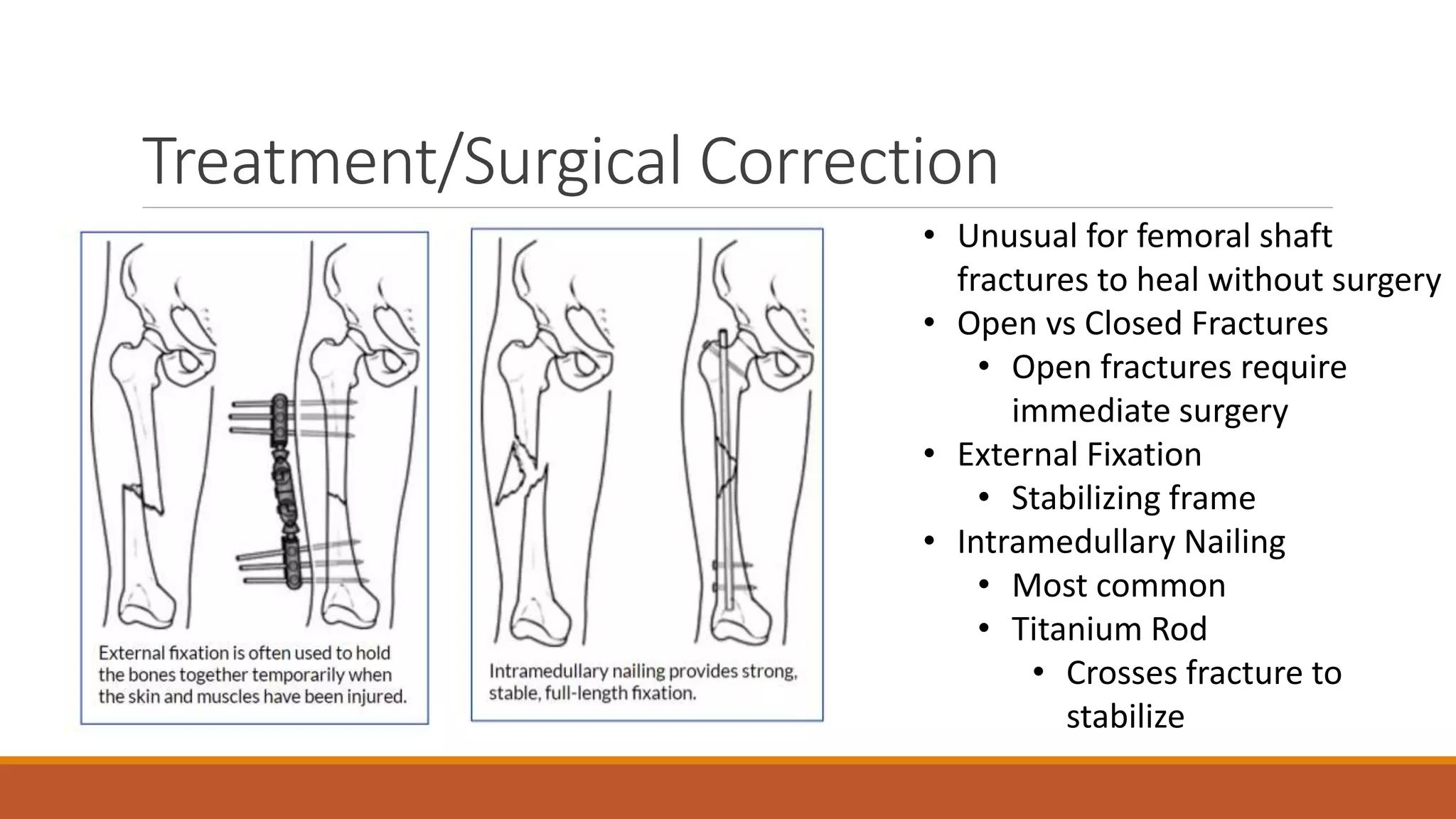 Femoral Shaft fracture | PPTX